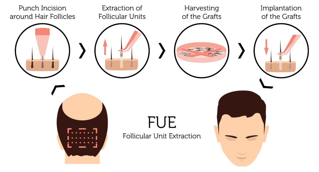 Hair Transplant - Niramoy Speciality Clinic